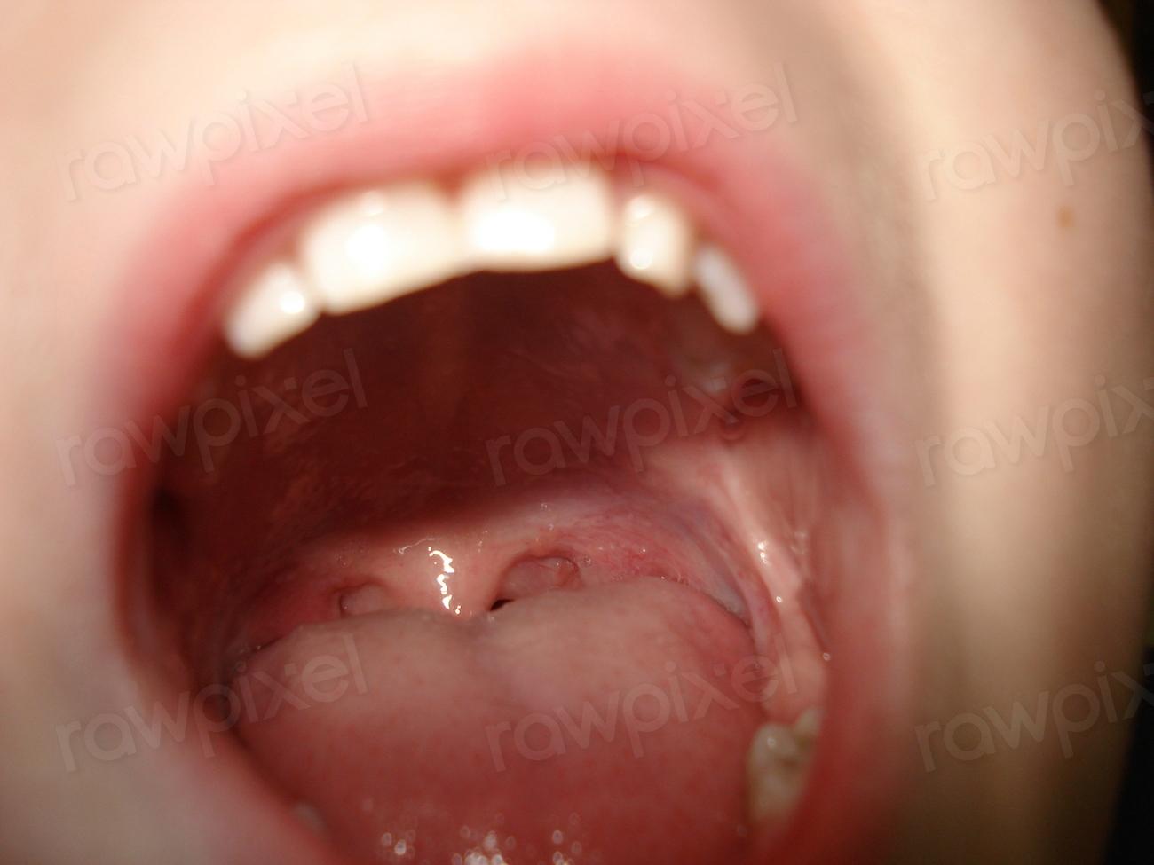 Vocal Nodules Causes: How to Identify and Address Them